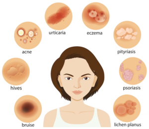 Skin Diseases - Symptoms, Causes, Treatment, Prevention