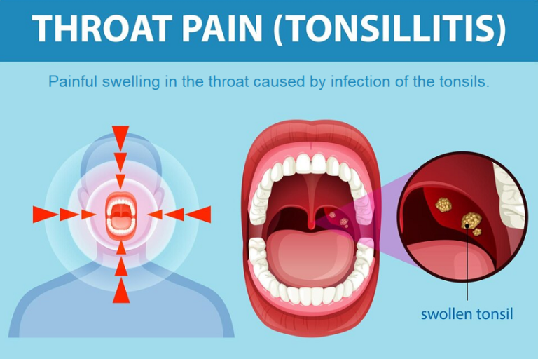 Tonsillitis: Causes, Symptoms and Treatments - UPLARN